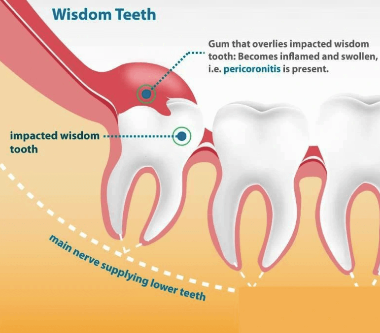 Wisdom tooth Extraction Costs (Price breakdown) — Affordable implants ...