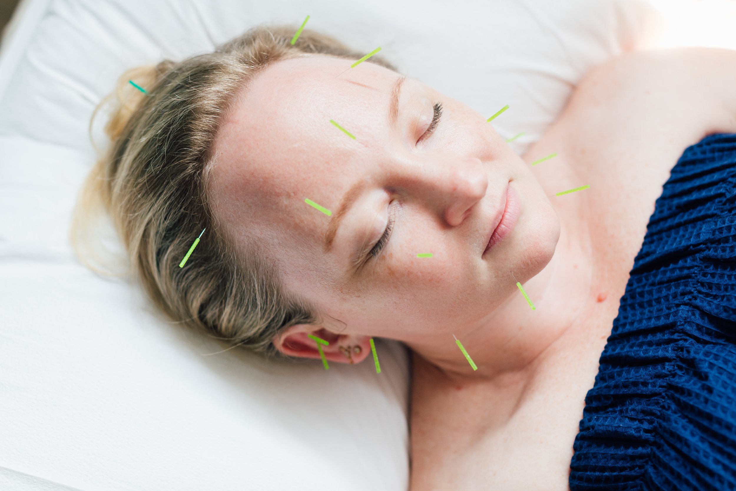 Acupuncture în Stamford and Westport