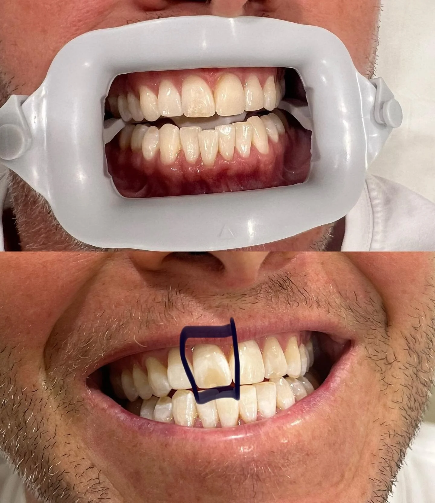 The Teeth Whitening Boutique | Sydney & Noosa