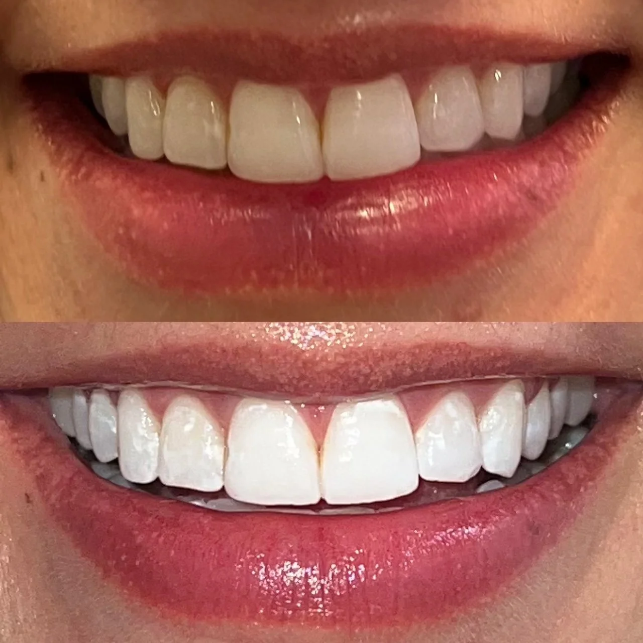 Client Whitening Results — The Teeth Whitening Boutique