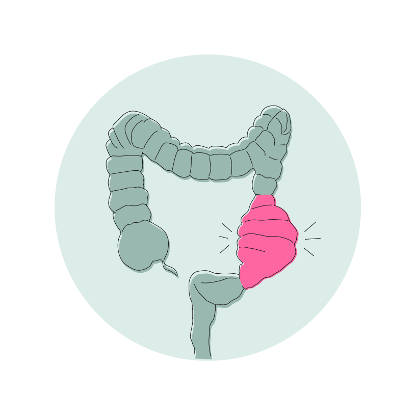 Constipation chronique — Laboratoire de santé pelvienne