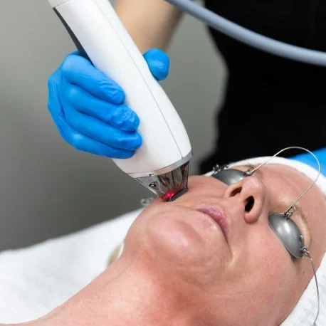 Aesthetic Laser Treatments — Rejuvenations Medi Spa