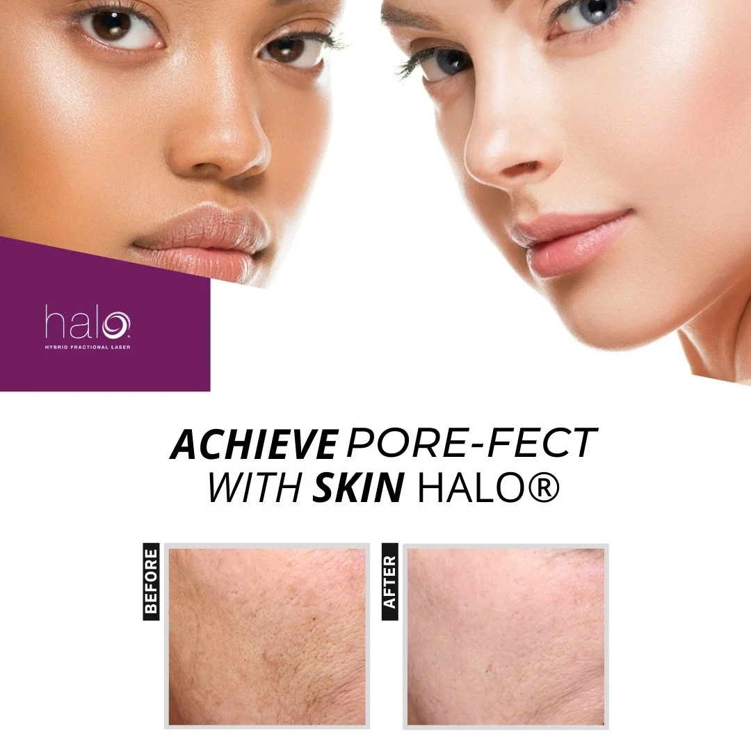 Halo Laser Treatment | Sciton Laser Skin Resurfacing in Portland, Maine — Rejuvenations Medi Spa
