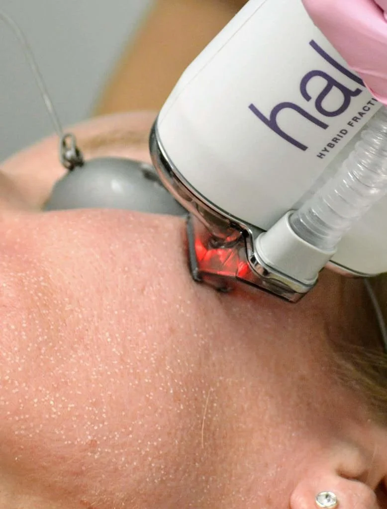 Halo Laser Treatment | Sciton Laser Skin Resurfacing in Portland, Maine — Rejuvenations Medi Spa