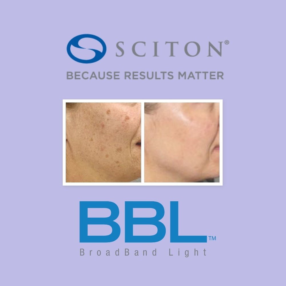 BBL BroadBand Light Portland, Maine — Rejuvenations Medi Spa