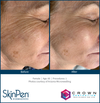 SkinPen® Precision Microneedling Skin Rejuvenation — Clinical Cosmetics