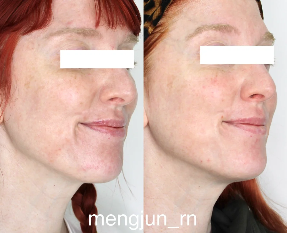 PRP (Platelet Rich Plasma) Skin Rejuvenation / Hair Restoration ...