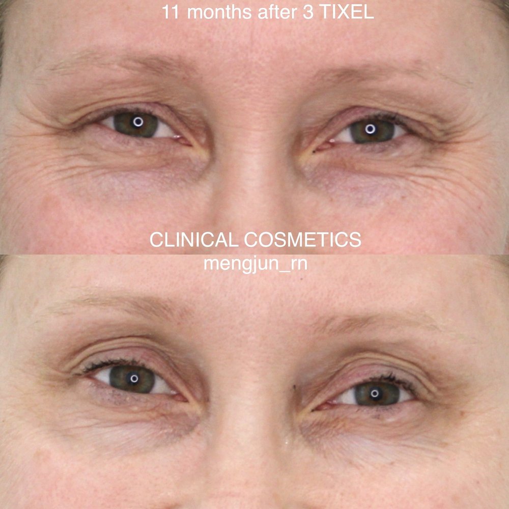 TIXEL Skin Tightening — Clinical Cosmetics