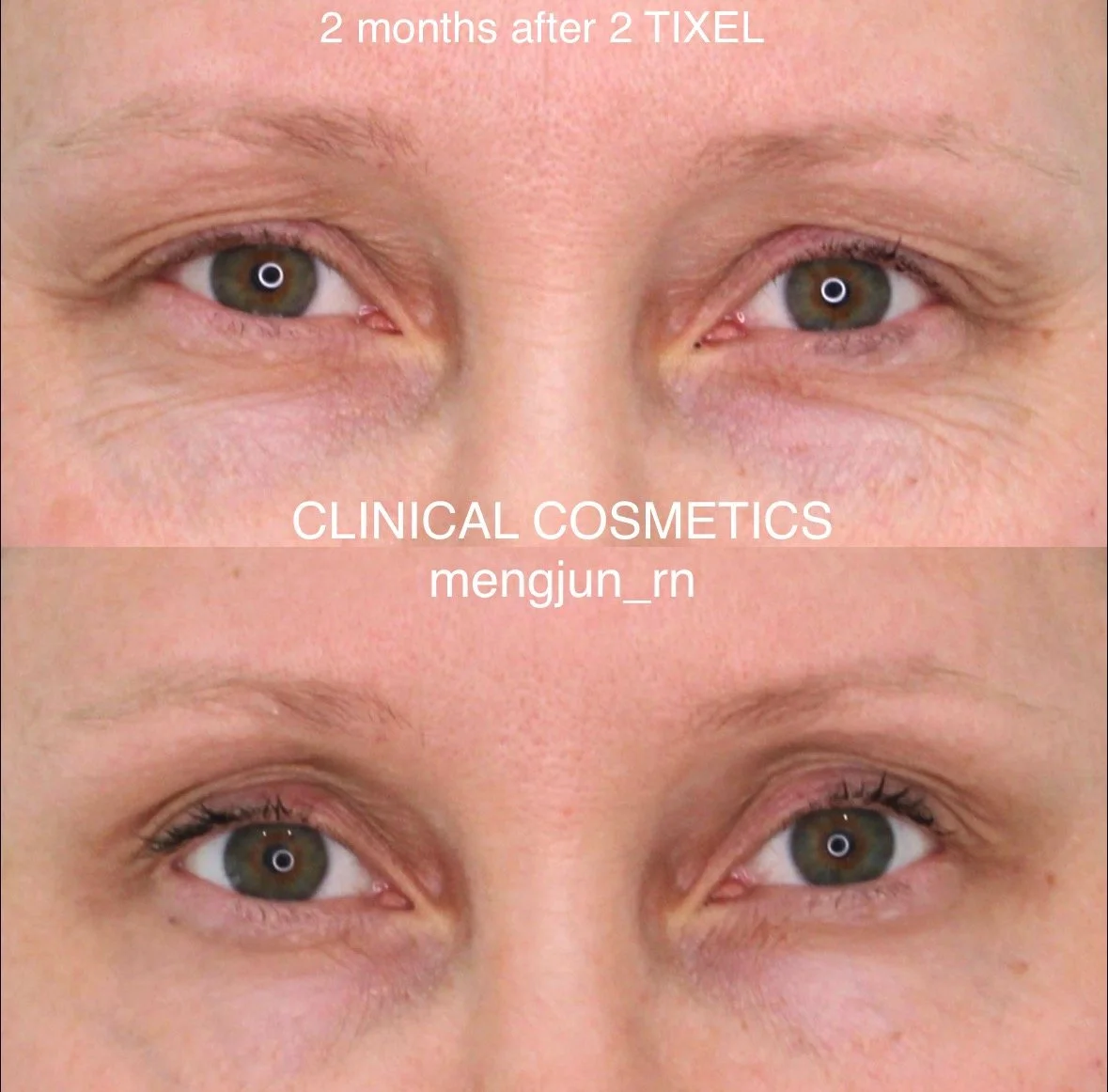TIXEL Skin Tightening — Clinical Cosmetics