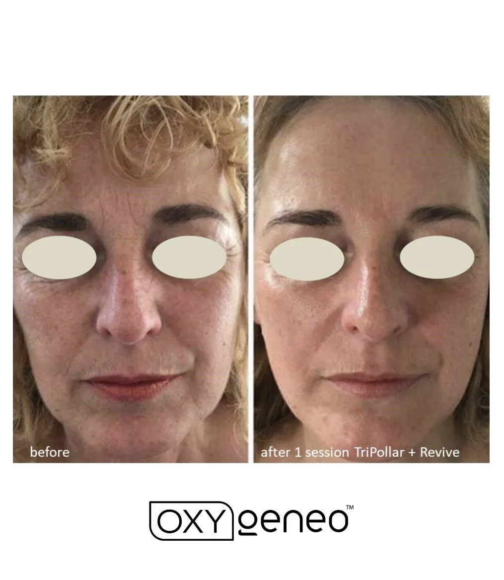 OxyGeneo™ (Glo2) 4-in-1 Super Facial — Clinical Cosmetics