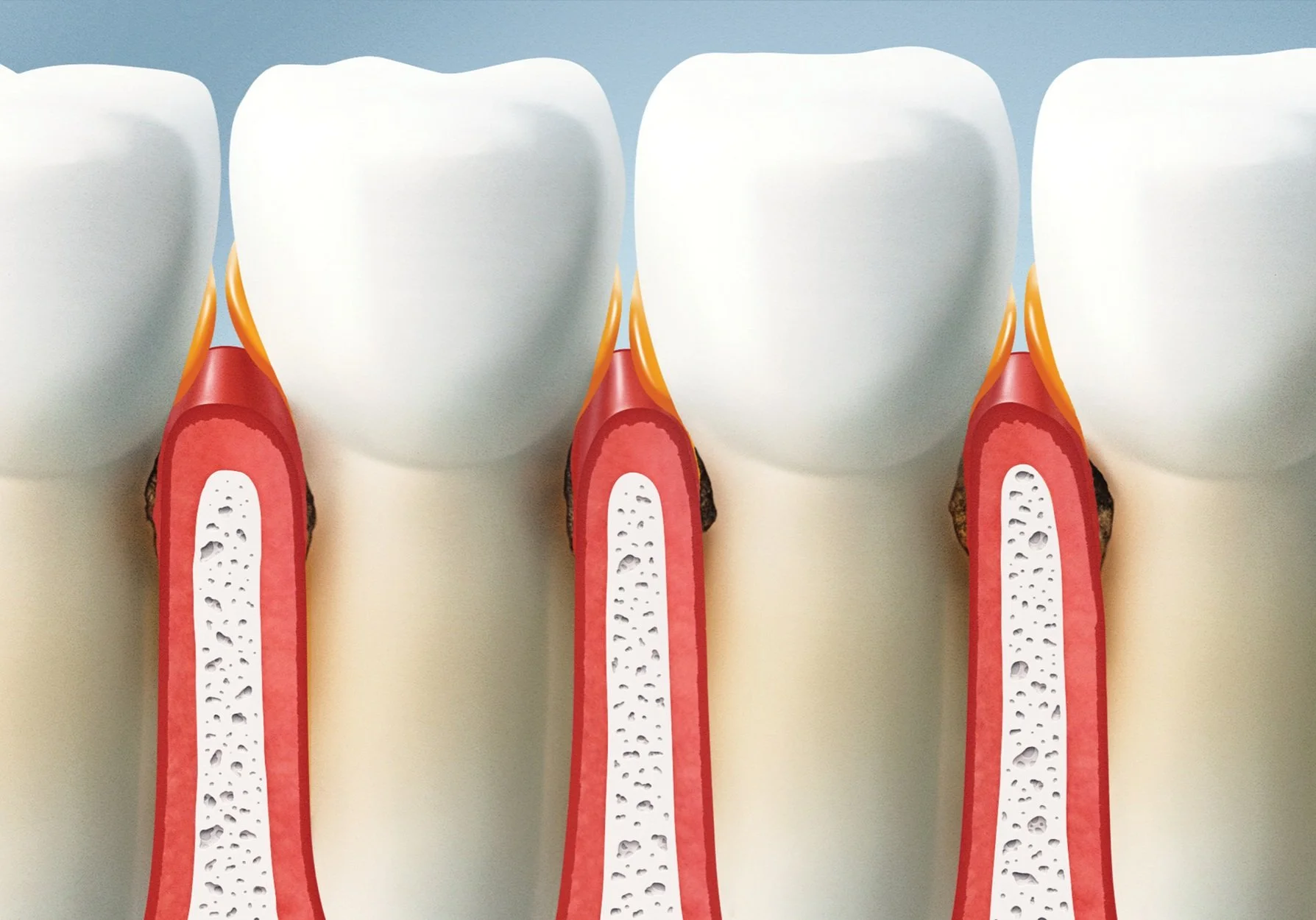 Gum Treatment — Smilecraft