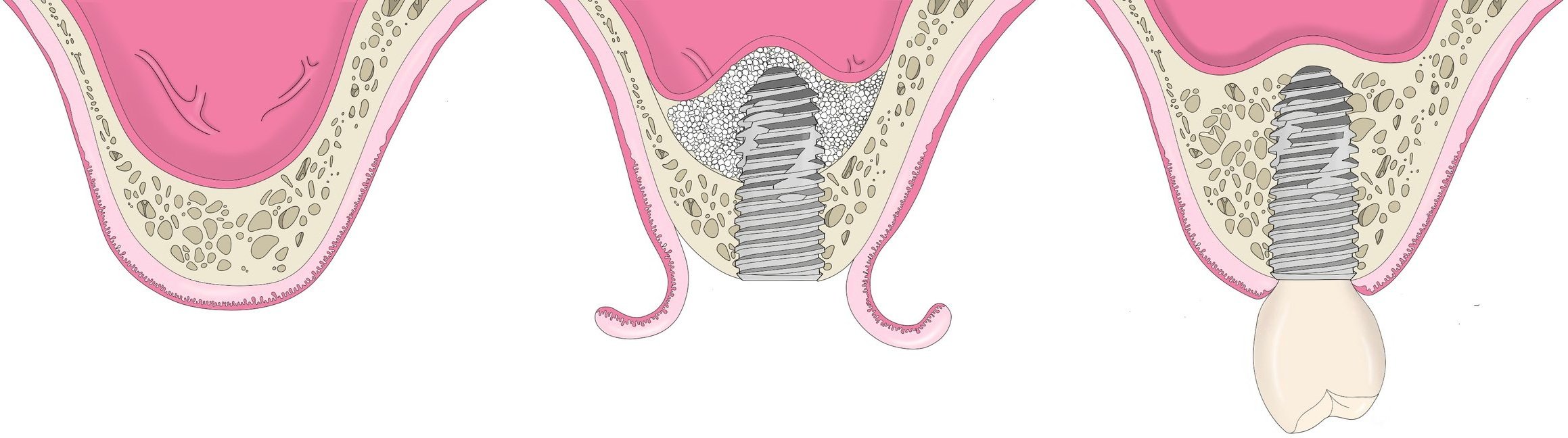 Surgical — Lagrange Periodontics