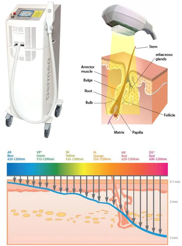 IPL Hair Removal Experts, Bethlehem, Tauranga — About You Medi Spa