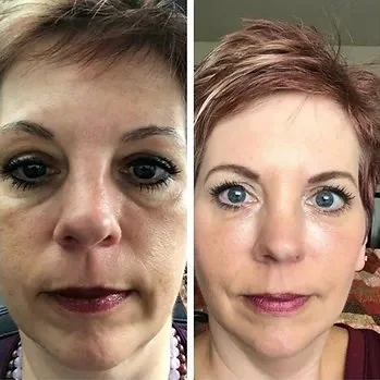 Bellafill — Moonstone Medical Aesthetics