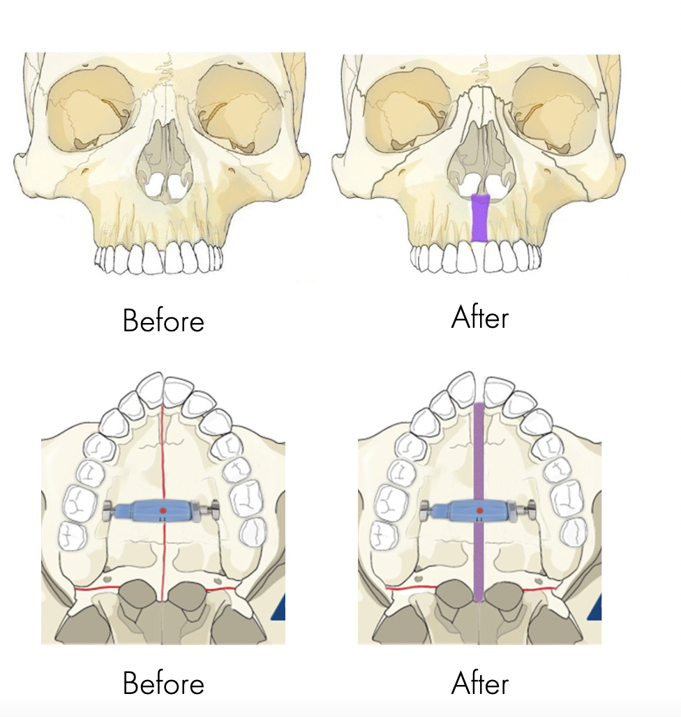 Nasomaxillary Expansion — Sleep Institute