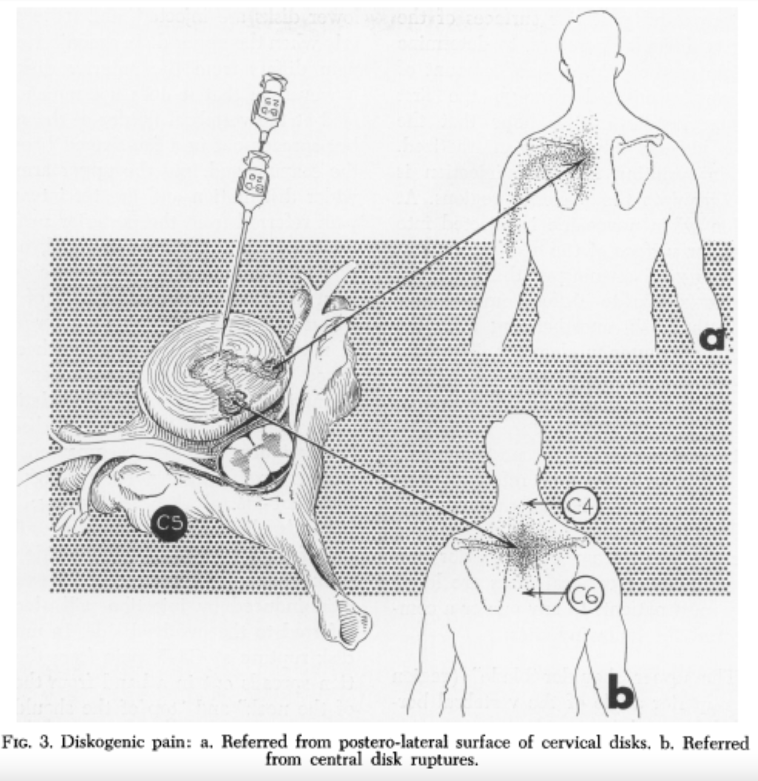 UNDERSTANDING CLOWARD SIGN | Rehab Code