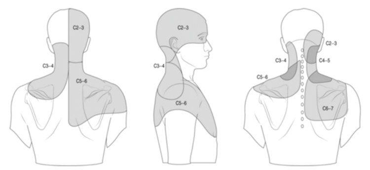 UNDERSTANDING CLOWARD SIGN | Rehab Code