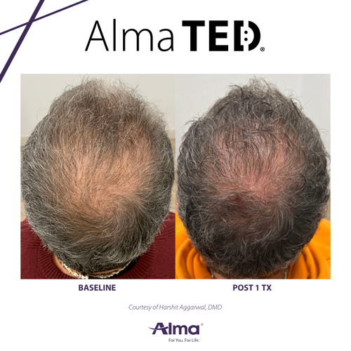 Alma TED's TransEpidermal Delivery: A Breakthrough in Hair Restoration ...