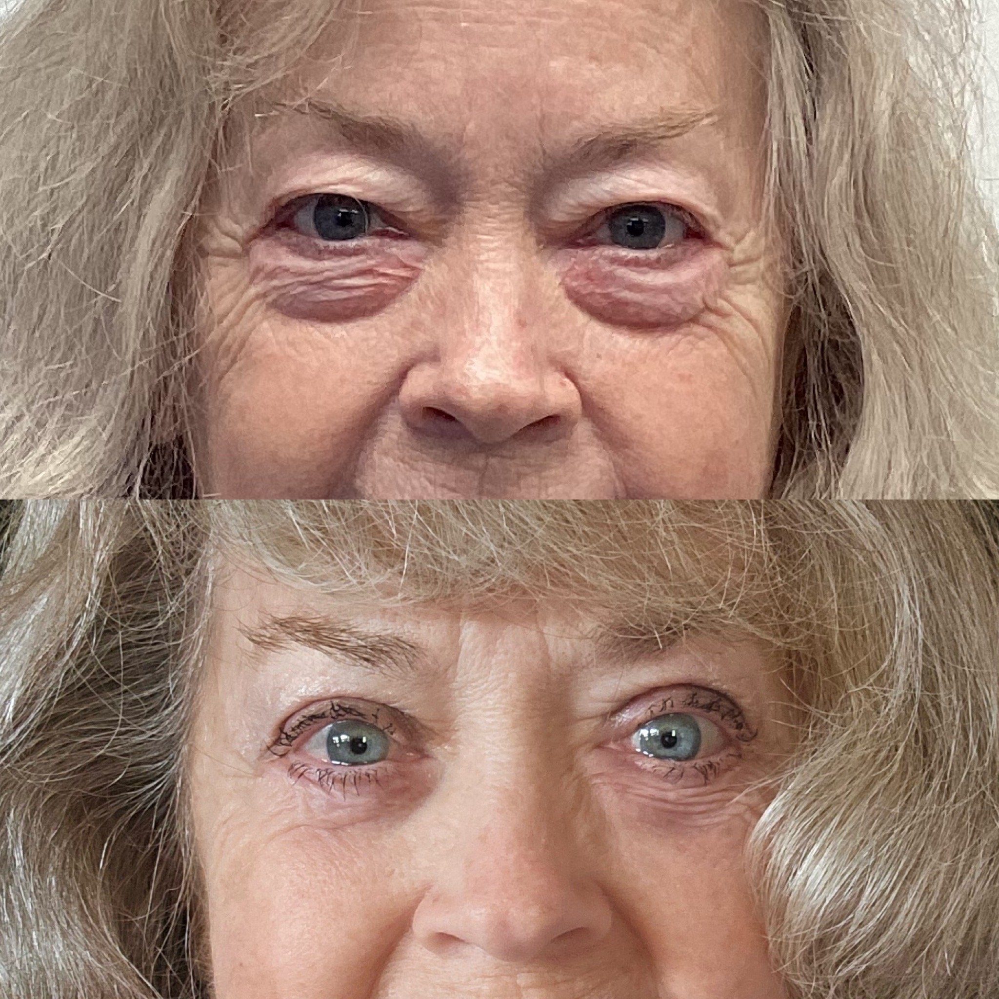 BLEPHAROPLASTY (EYES) — HATEF AESTHETICS