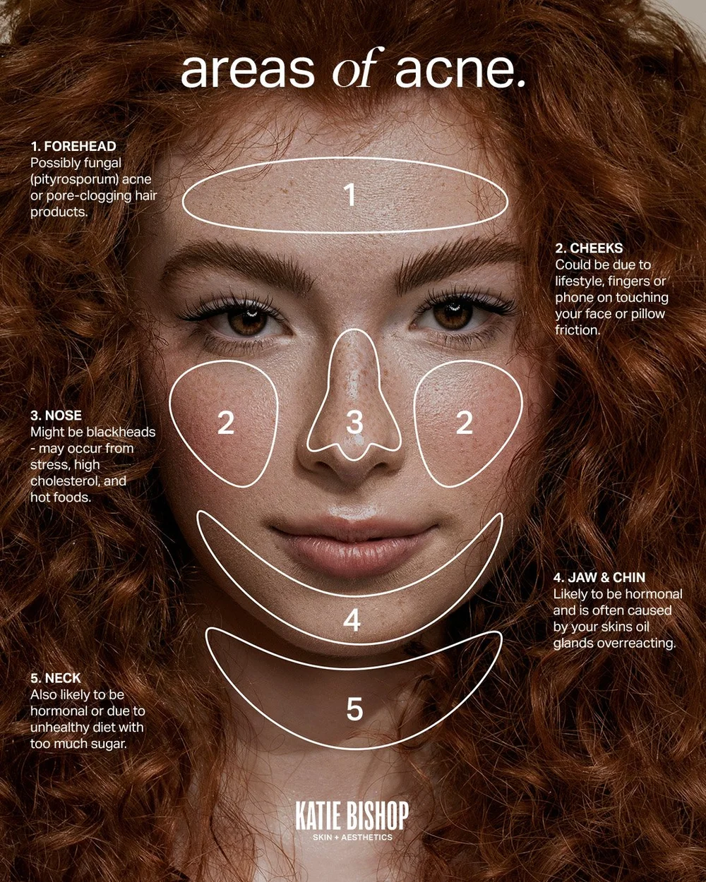 Skin SOS: Acne — Katie Bishop Skin + Aesthetics