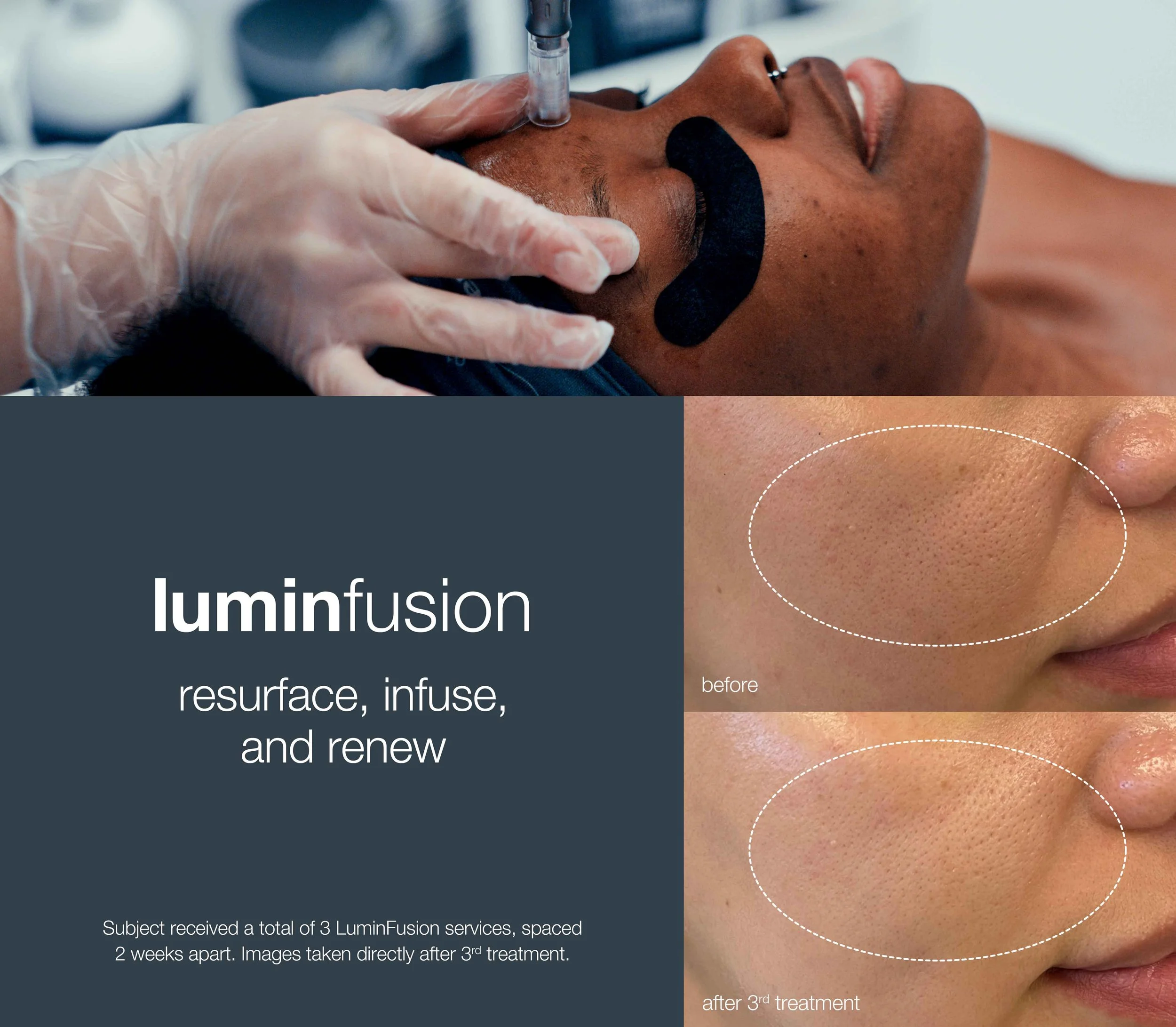 Bangkok's Best Clinic for Botox, Fillers, ULTRAcel Q+, PRP, Hydro ...