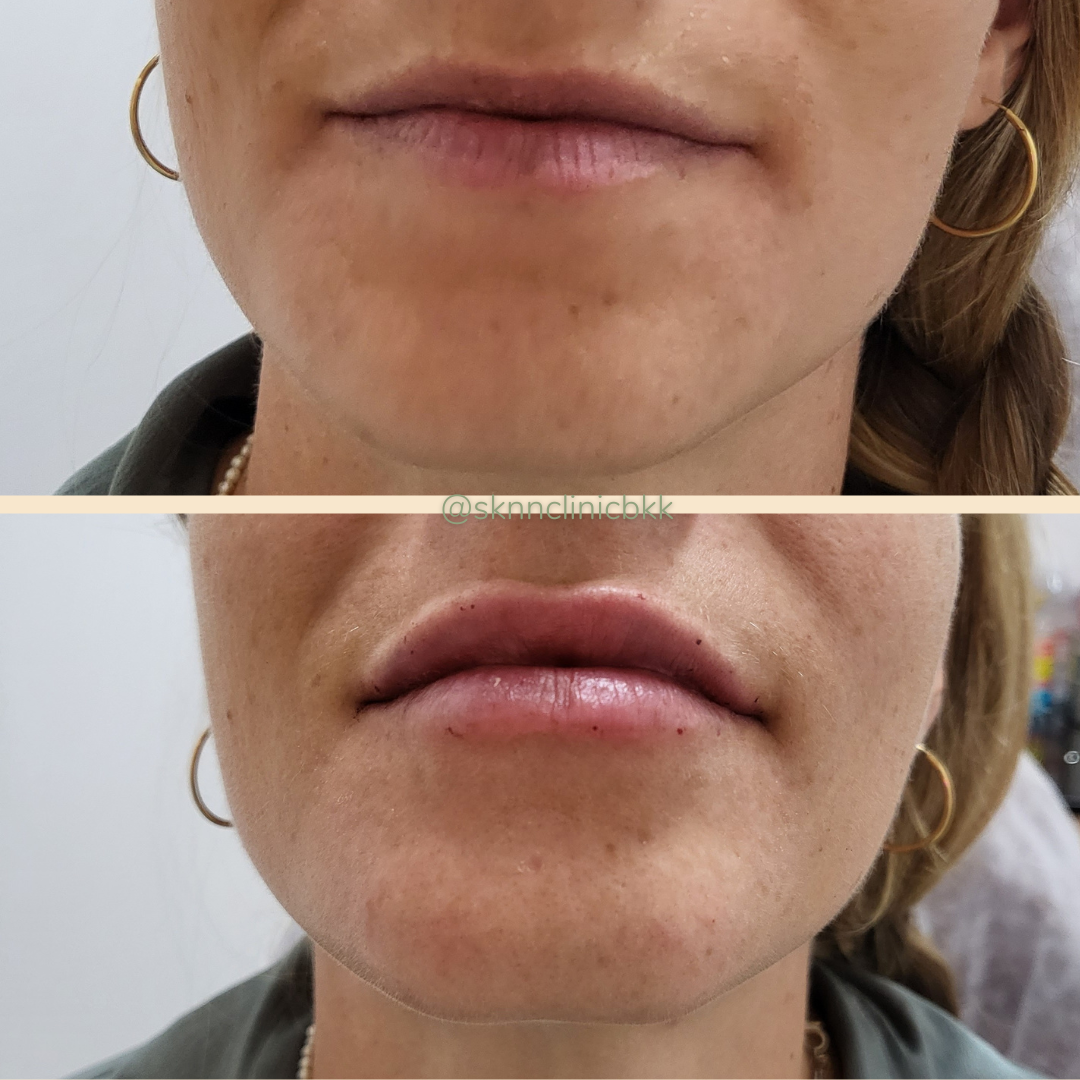 Bangkok's Best Clinic for Botox, Fillers, ULTRAcel Q+, PRP, Hydro ...