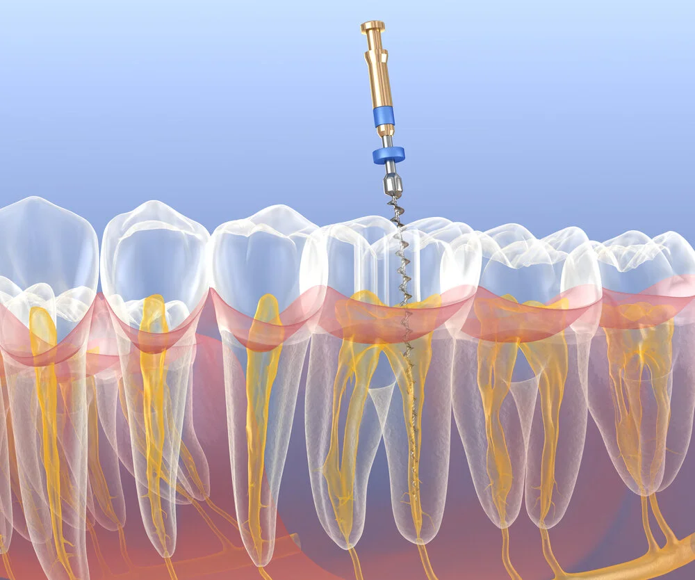 A Detailed Guide on Root Canal Process