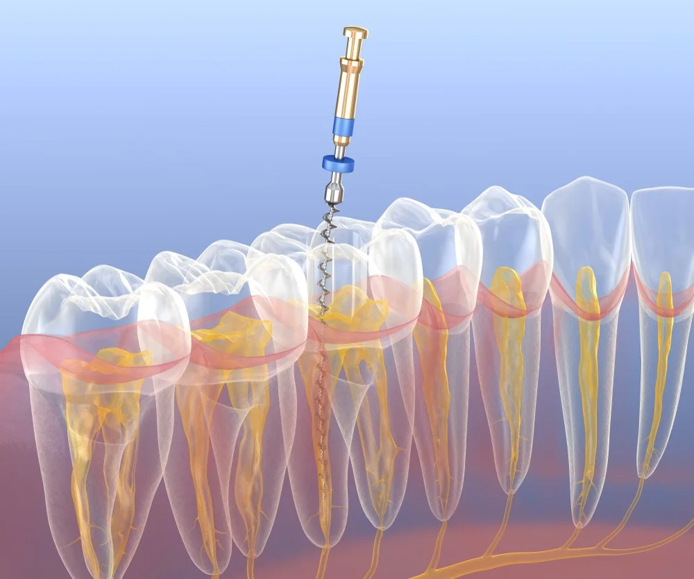 Debunking the Top 5 Myths about Root Canals