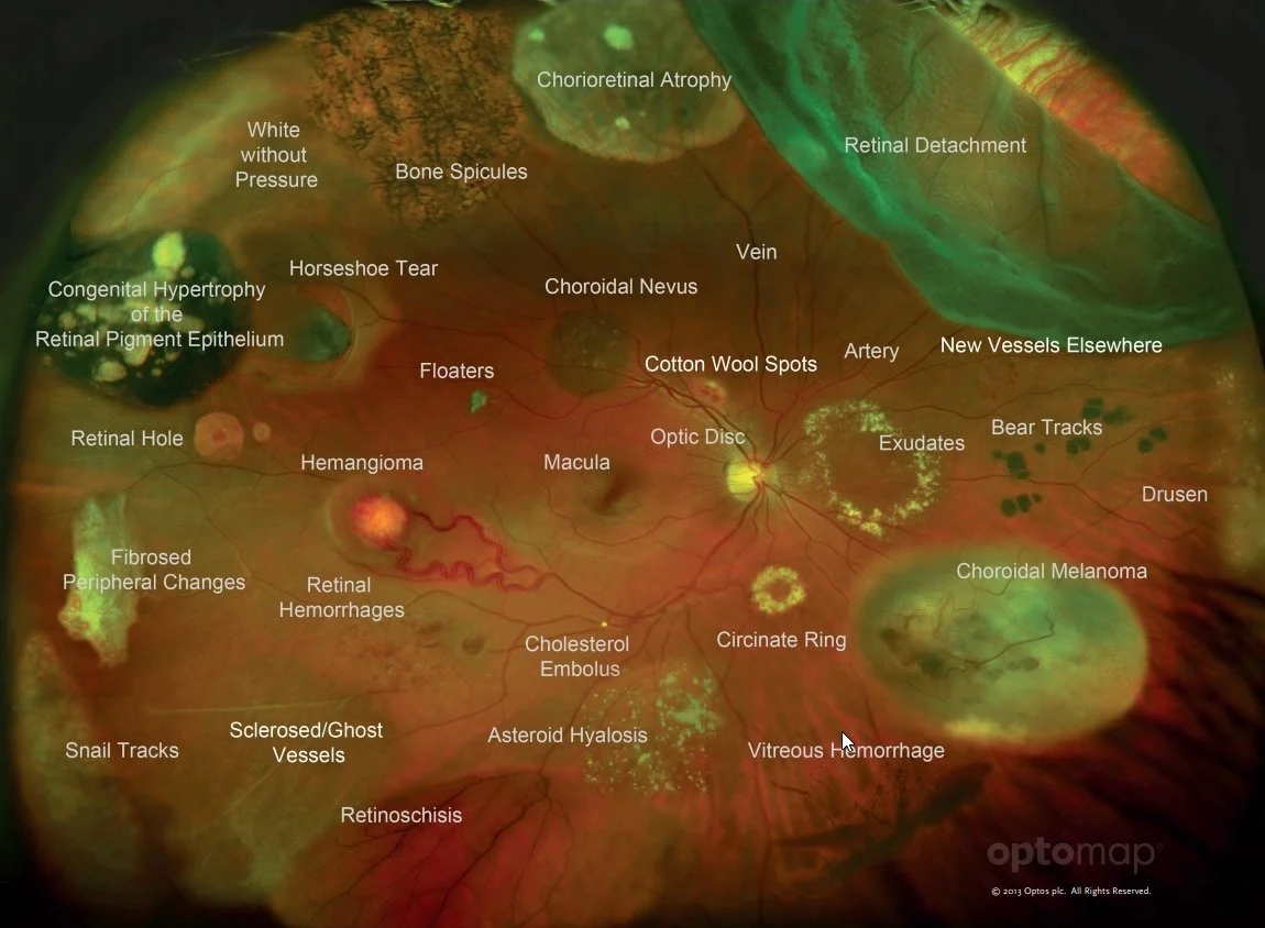 Optomap® Ultra-Widefield Retinal Image — Eyeconic Eye Care