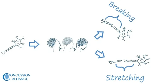 What happens to your brain when you get a concussion? — Concussion Alliance
