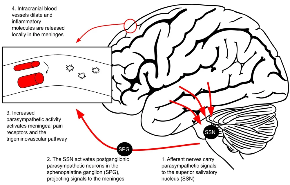 Headaches: Advanced Page — Concussion Alliance