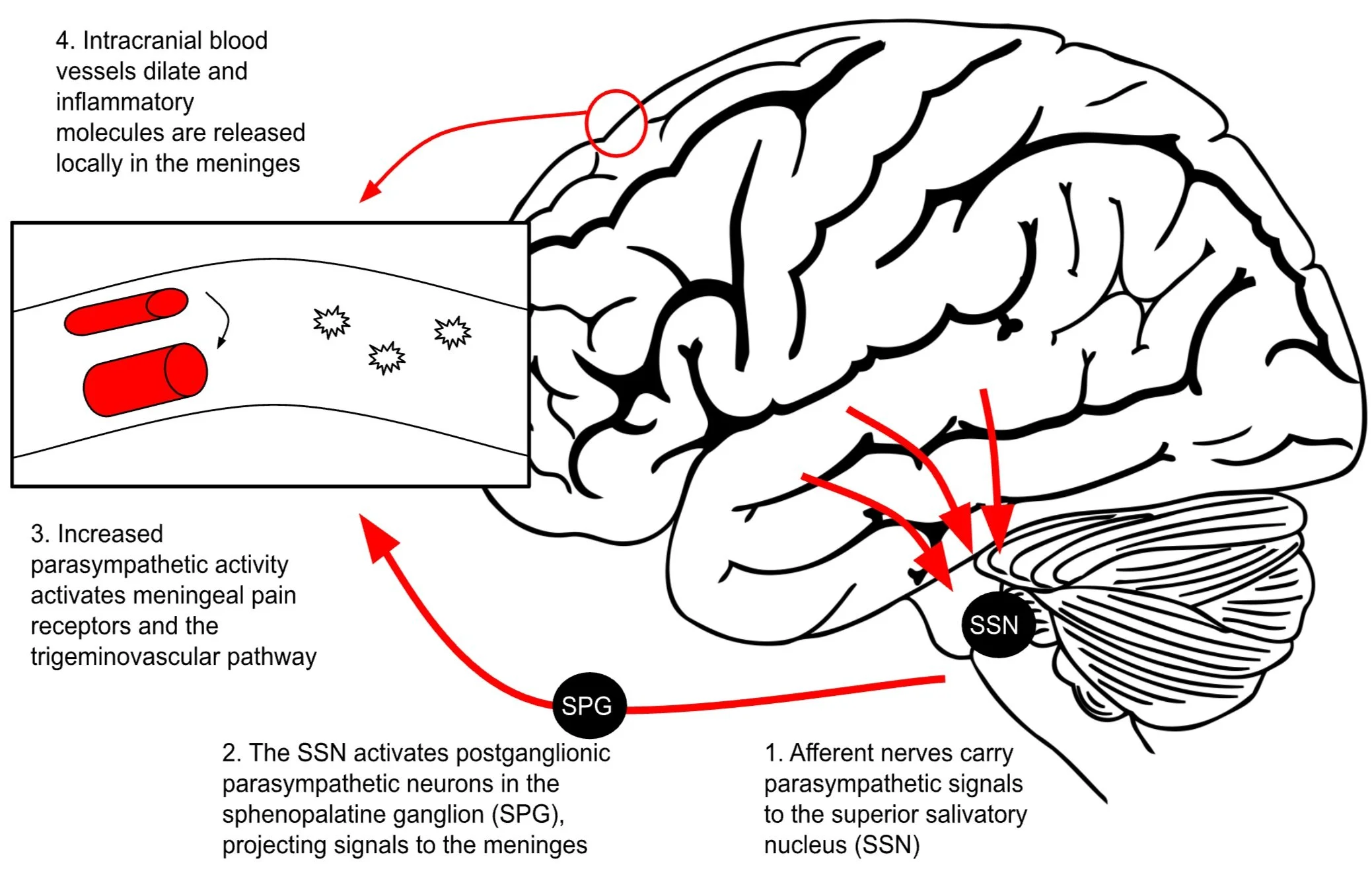 Headaches: Advanced Page — Concussion Alliance