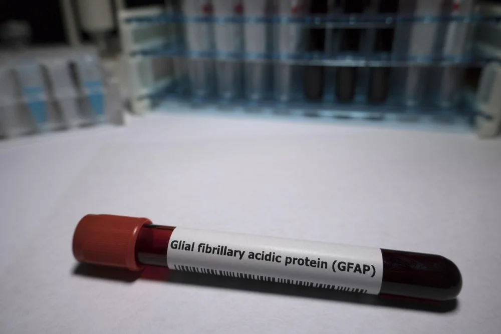 Blood biomarkers detect reduced brain structure volume associated with ...