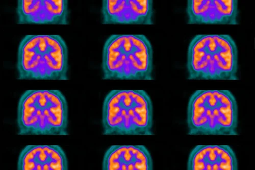 Study finds marker of functional brain activity and vasculature more ...