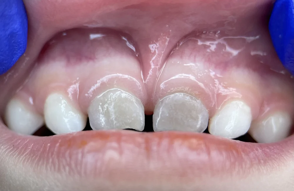 Dark or Discolored Baby Tooth — Primary Pearls