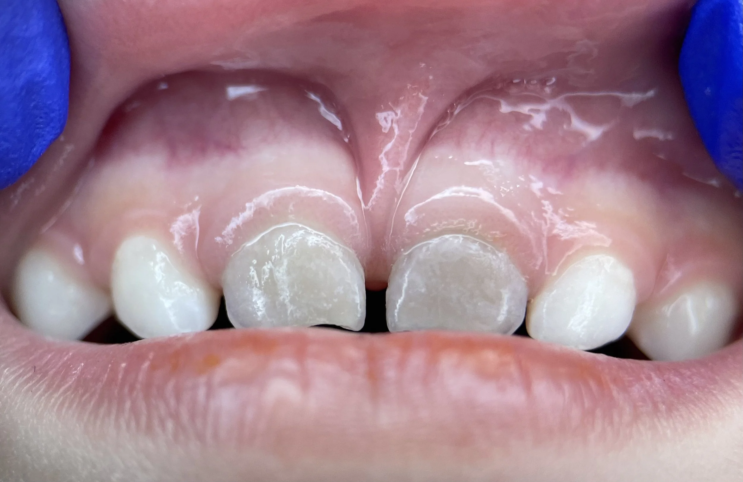 Dark or Discolored Baby Tooth — Primary Pearls