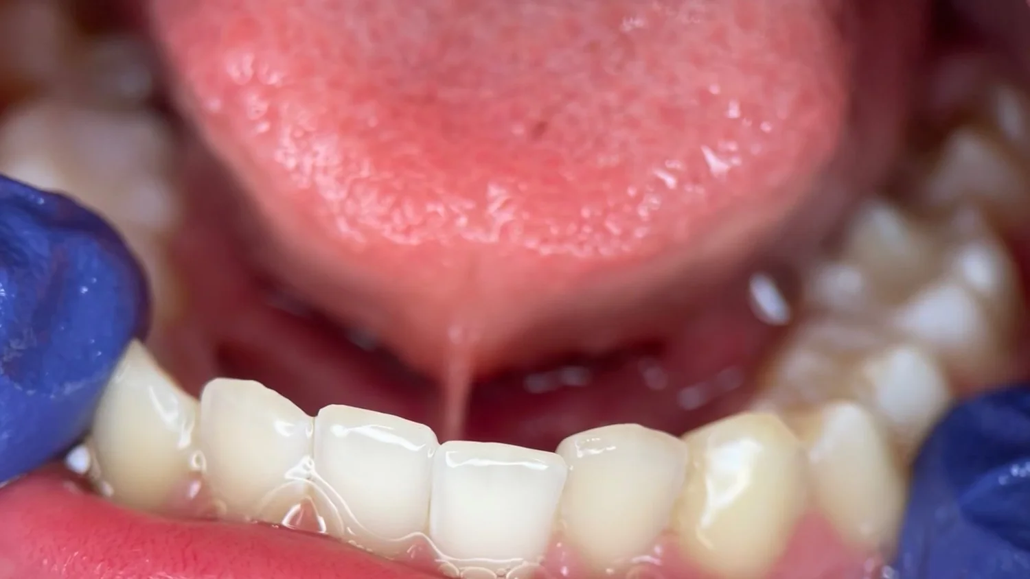 Frenums — Primary Pearls