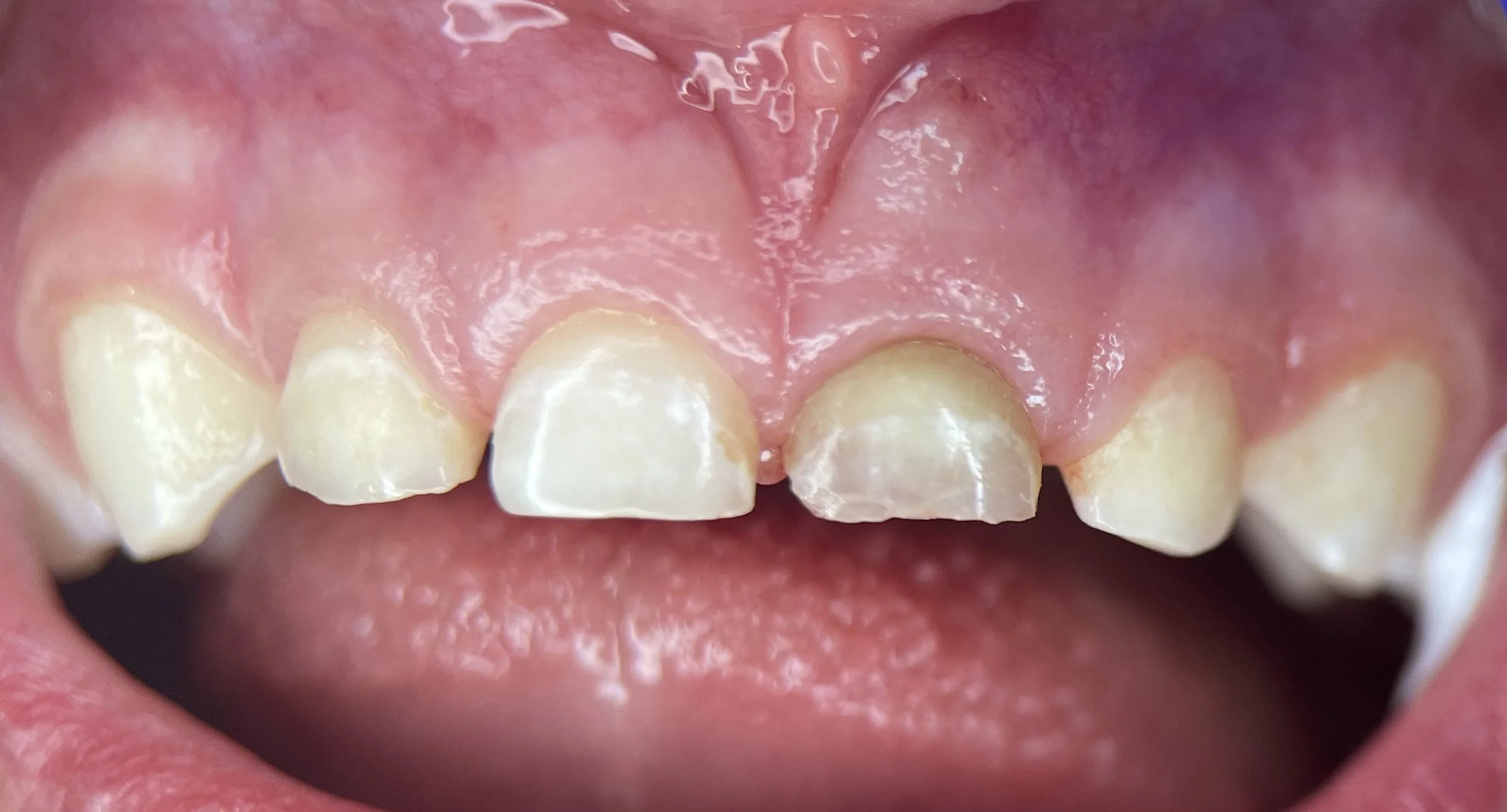 Dark or Discolored Baby Tooth — Primary Pearls