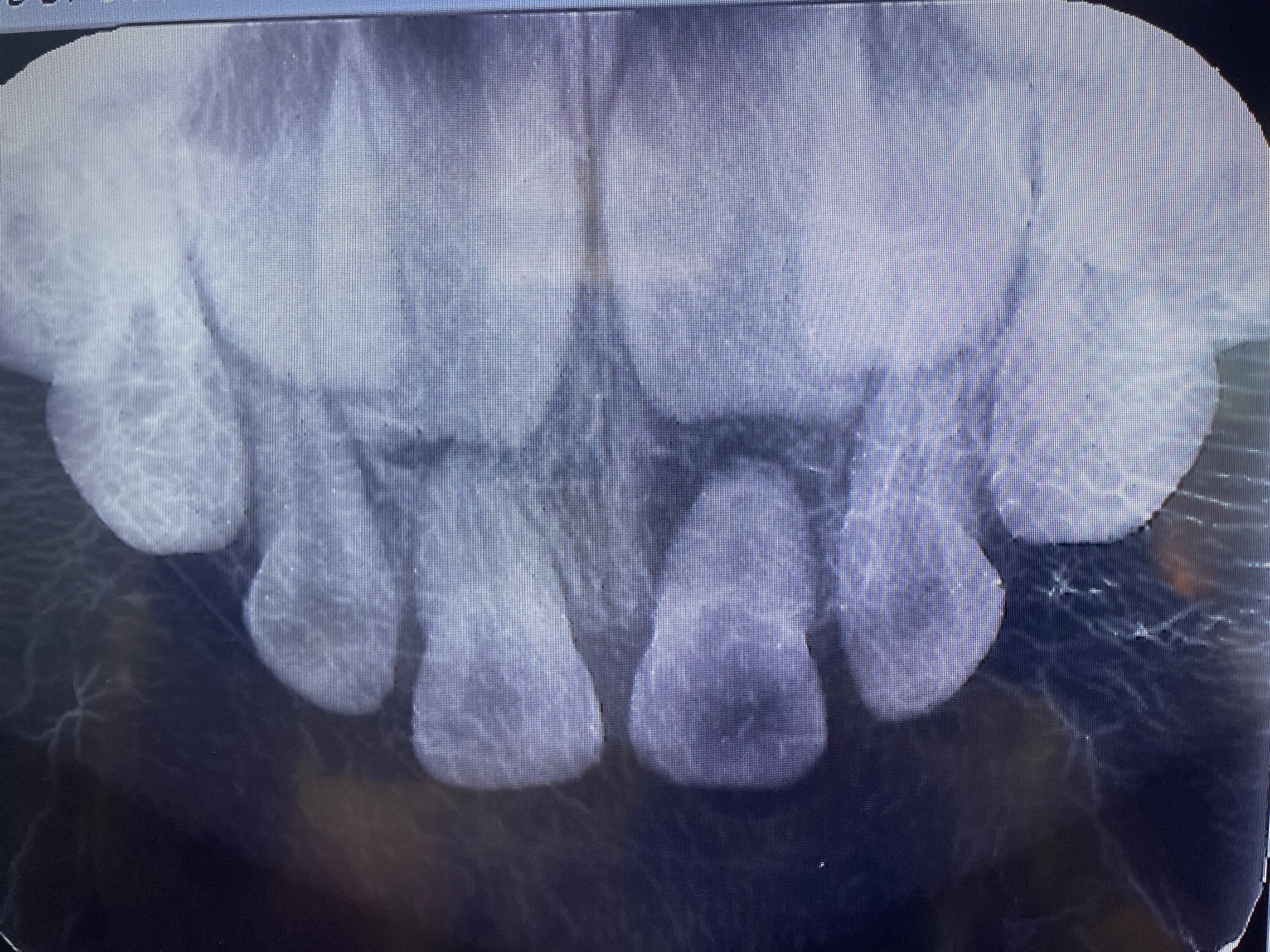 Dark or Discolored Baby Tooth — Primary Pearls