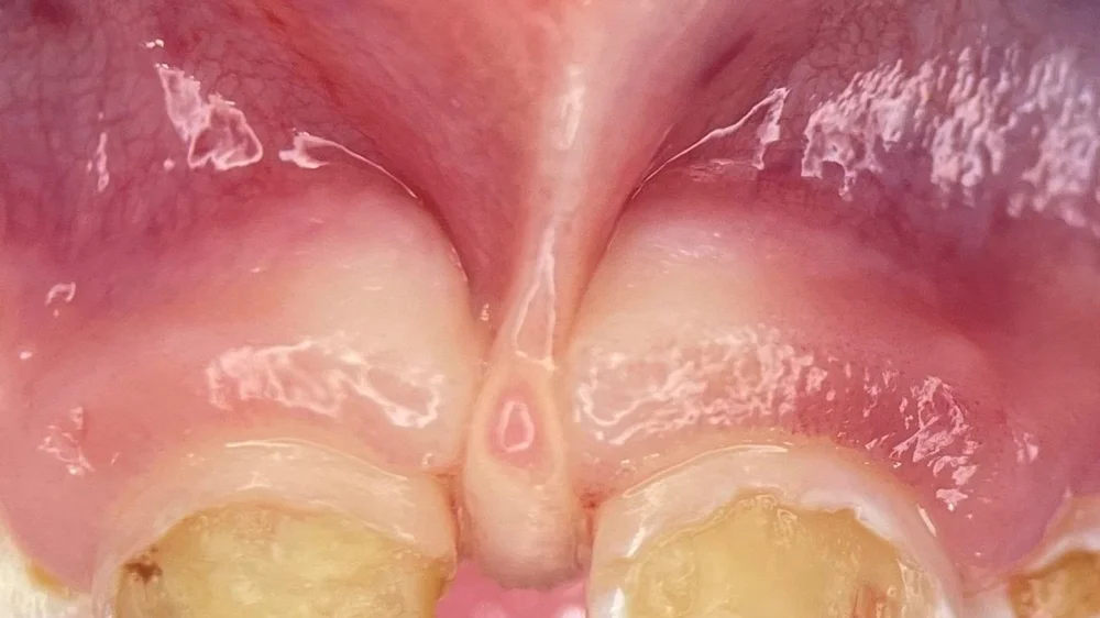 Frenums — Primary Pearls