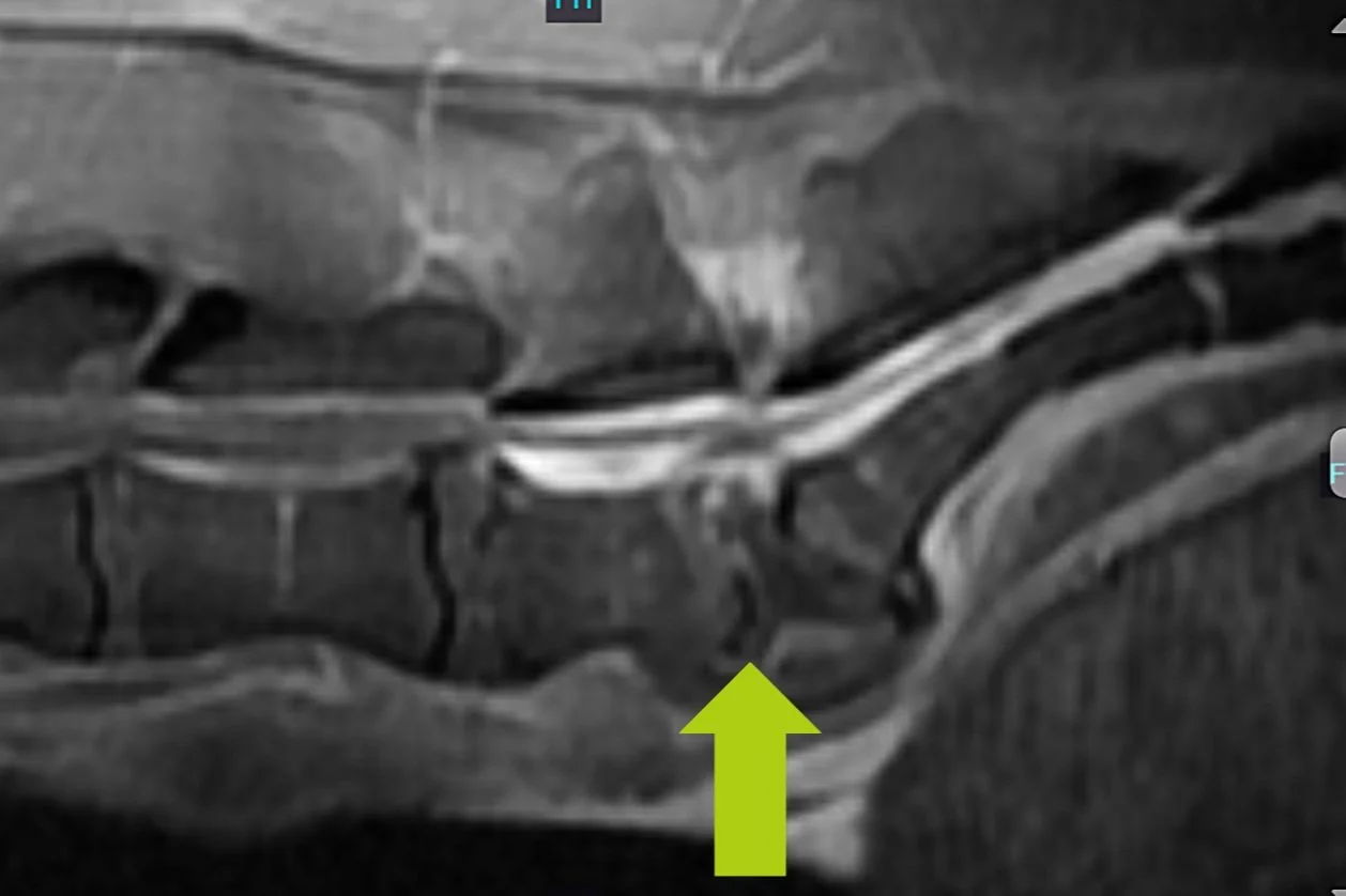 Diskospondylitis — vetneurochesapeake
