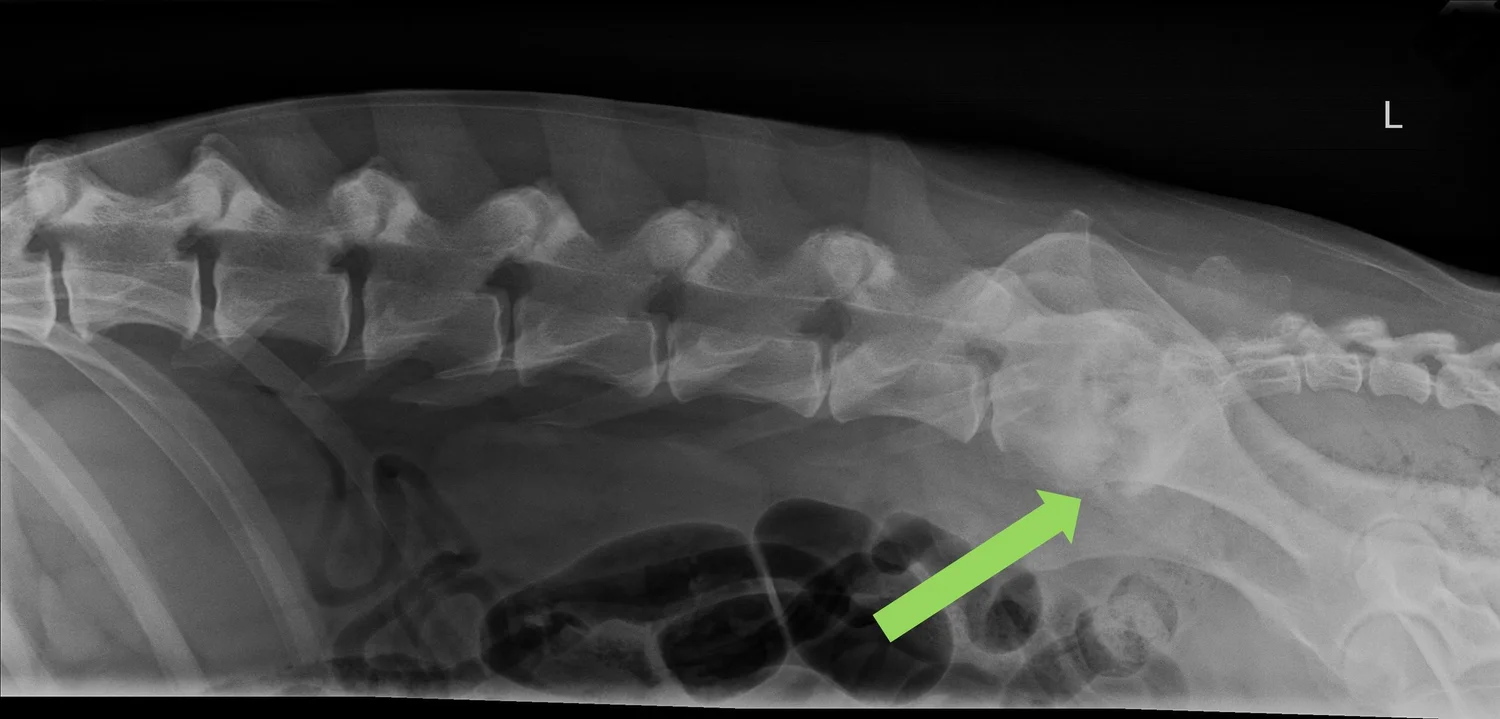 The Challenges of Bacterial Diskospondylitis Diagnosis and Treatment ...