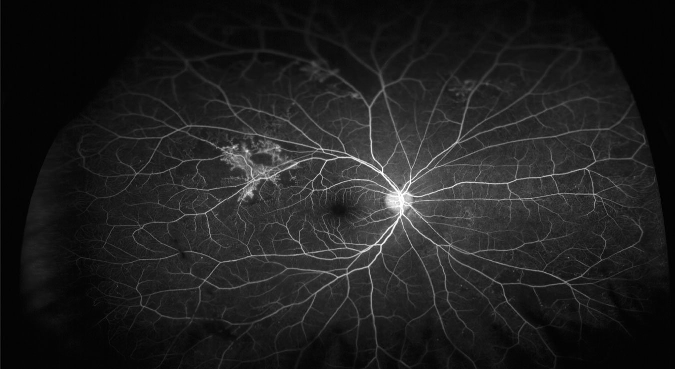 Treatment of Retinal Diseases — Ophthalmic Surgeons of Greater ...