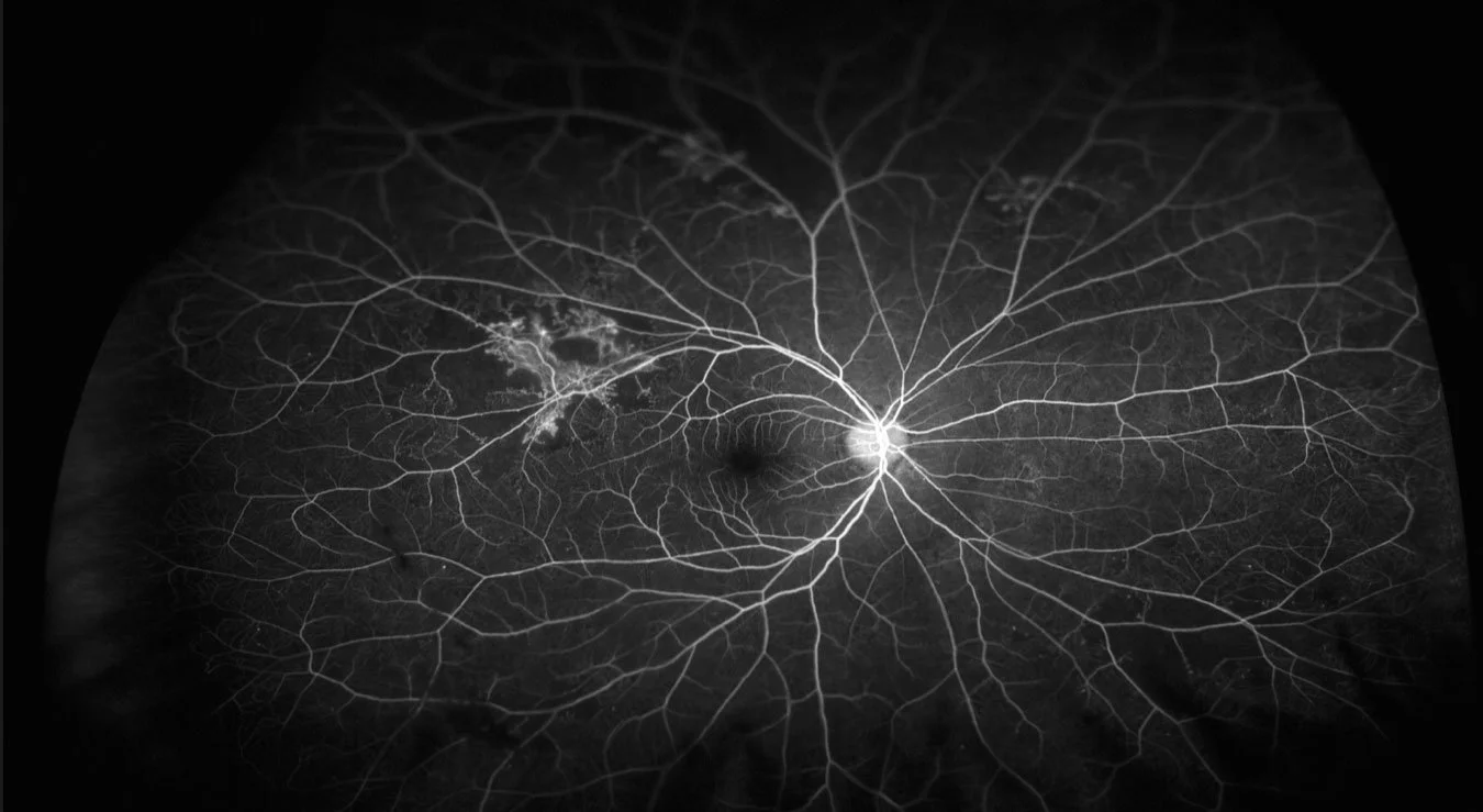 Treatment of Retinal Diseases — Ophthalmic Surgeons of Greater ...