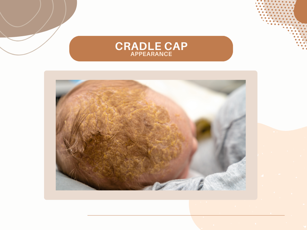 Cradle Cap — Sarah Mahmood, MD