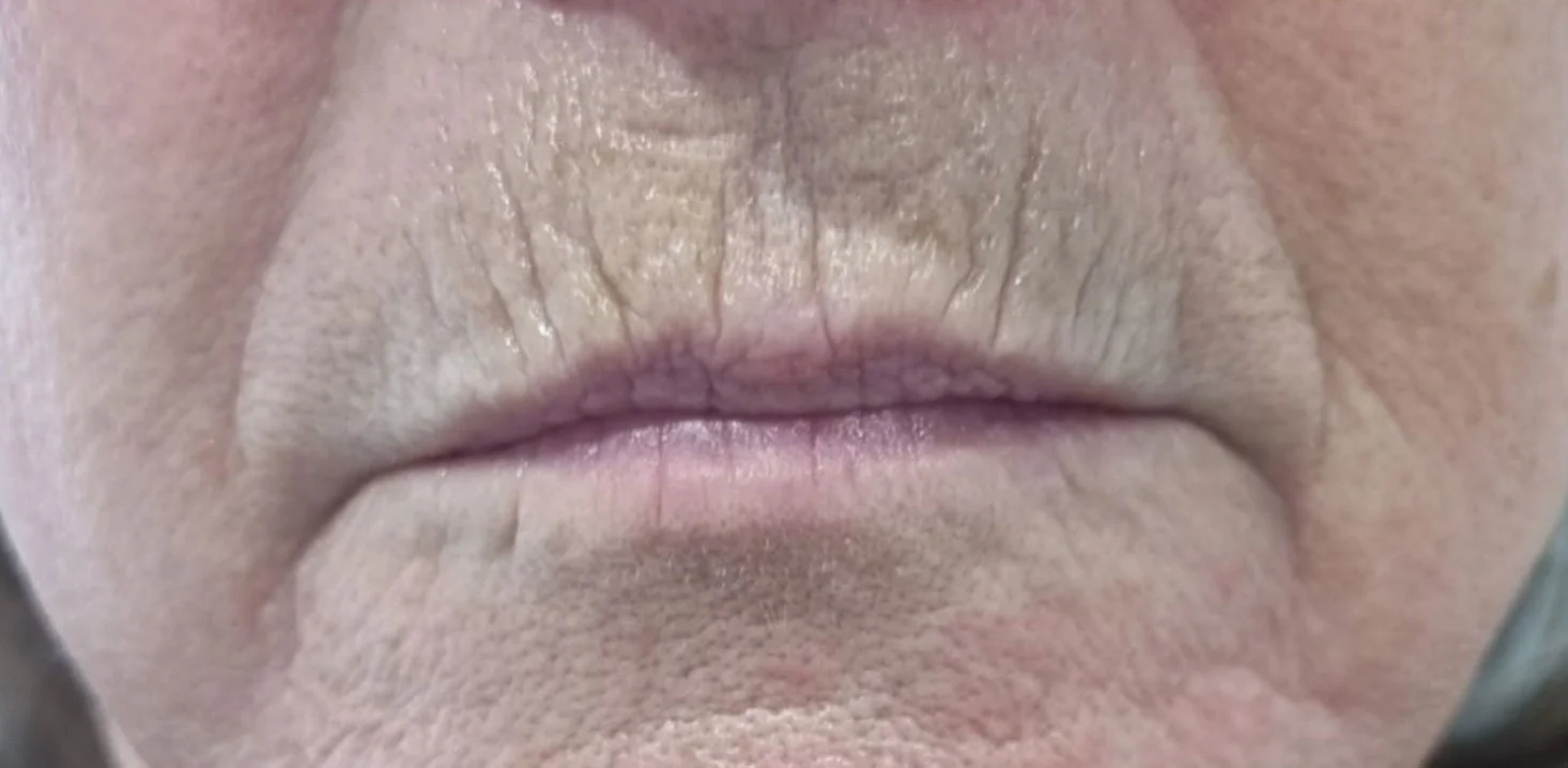 Dermal Fillers — Clinic Forty Three