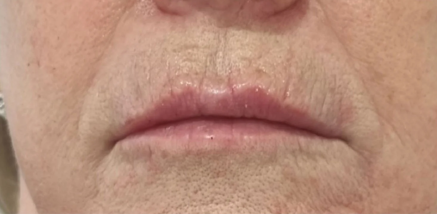 Dermal Fillers — Clinic Forty Three