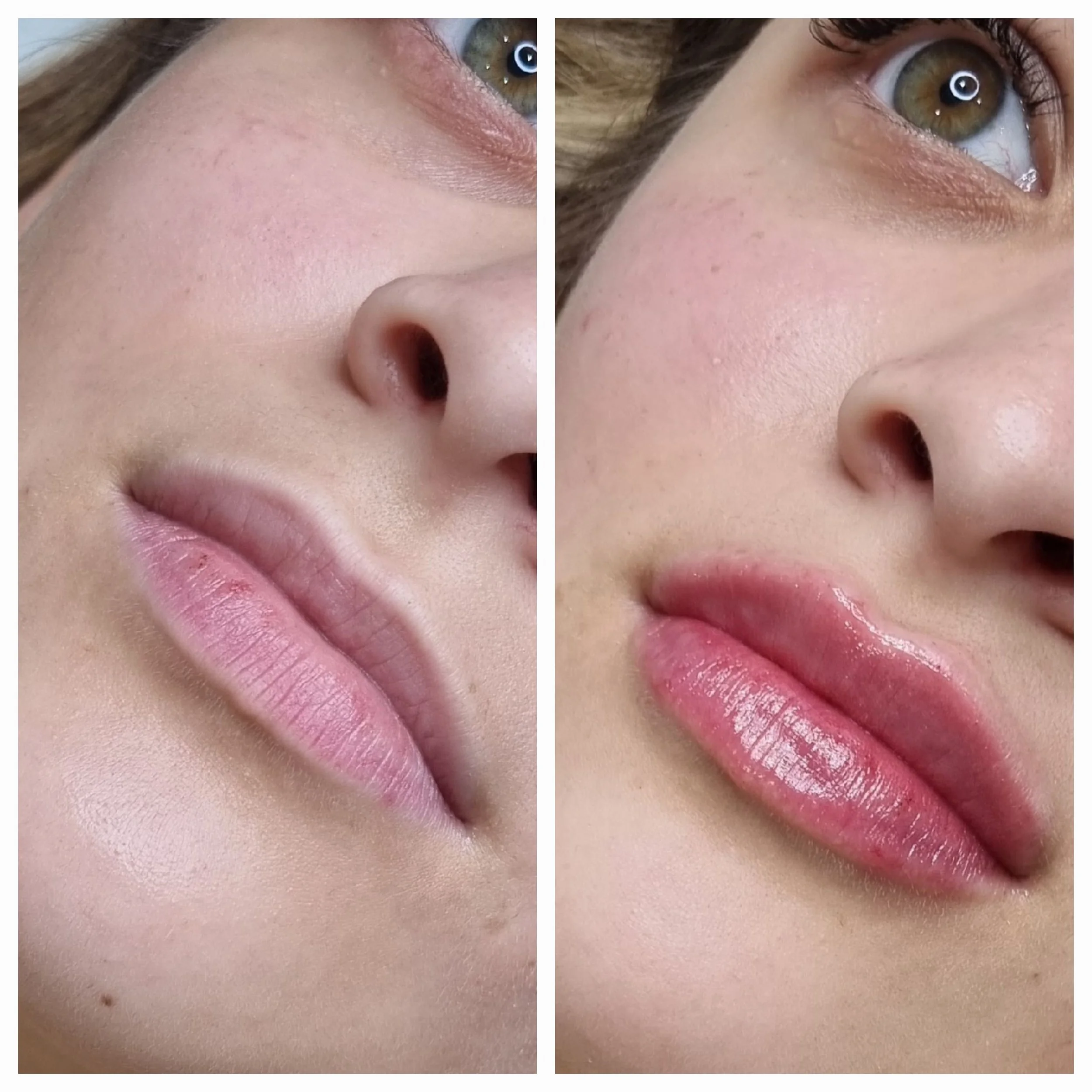 Lip Fillers — Clinic Forty Three