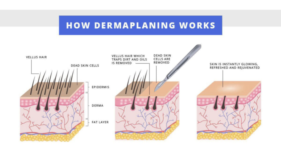 Improve the appearance of your skin with Derma-planing treatment ...