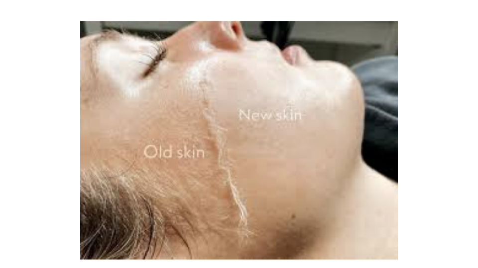 Improve the appearance of your skin with Derma-planing treatment ...
